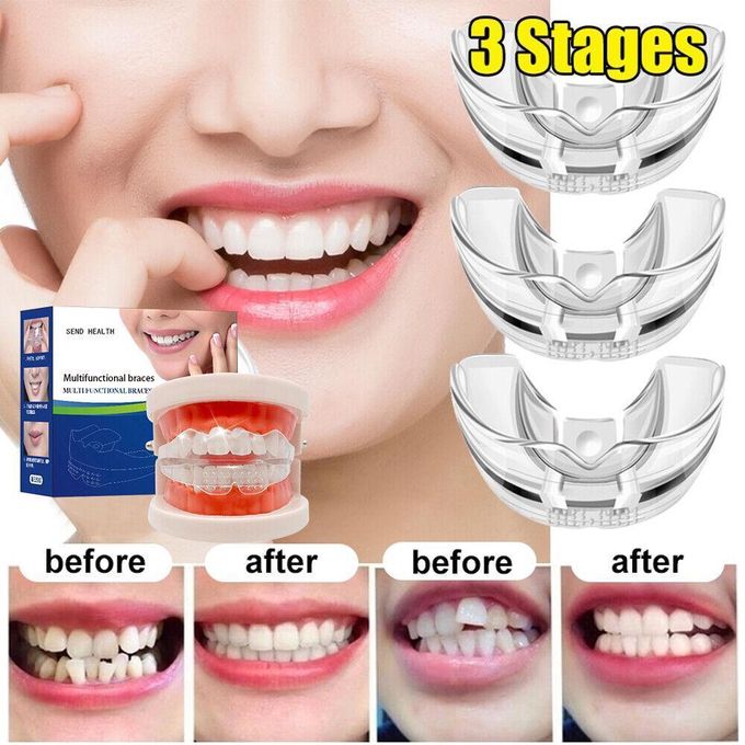Shop Generic 3-Stage Teeth Aligner Brace – Invisible
